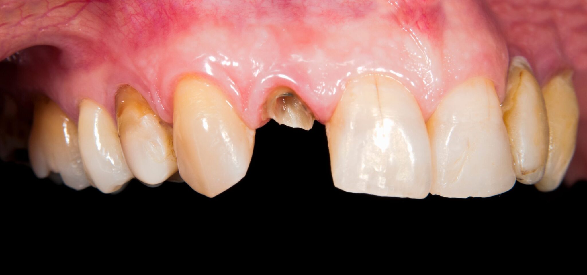 Fractured Tooth Extractions | Smile Dental Implant Center