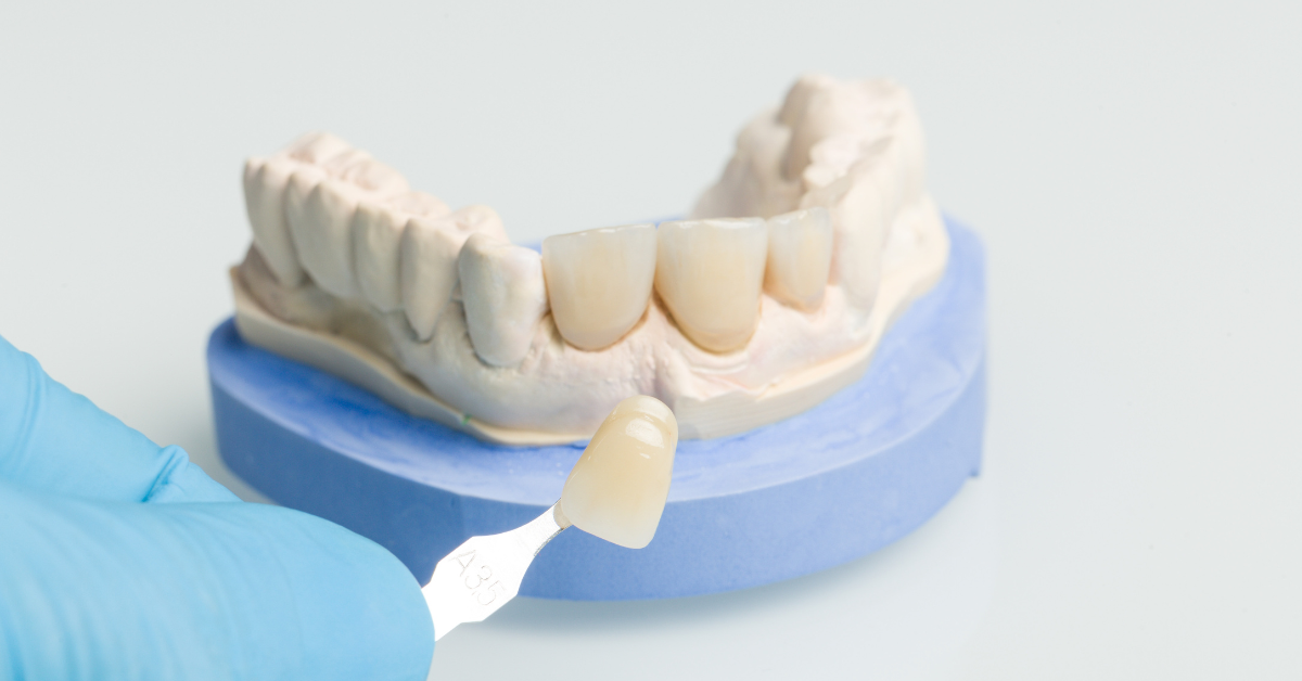 How To Choose The Best Dental Crown For You - Smile Dental Implant Center